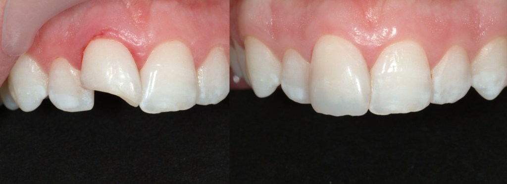 Root Canal Front Tooth Before And After